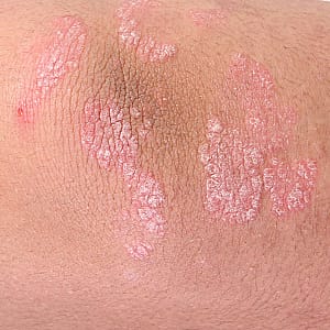 Psoríase – Carolina Miranda Dermatologia